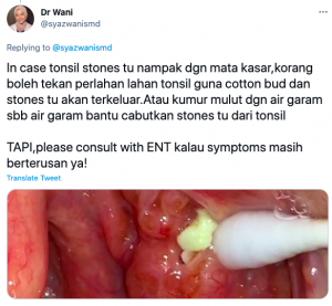 "Ketulan Putih & Berbau Busuk Dalam Mulut" - Doktor Gigi Ini Jelaskan ...