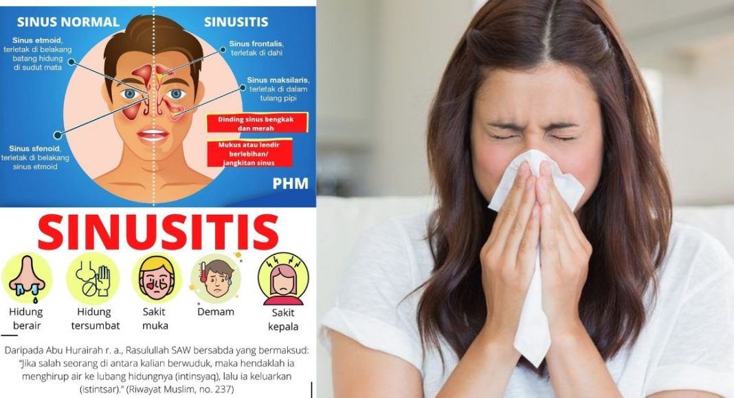 Hidung Berair & Tersumbat, Gejala Radang Sinus. Ini Cara Atasinya Elak ...