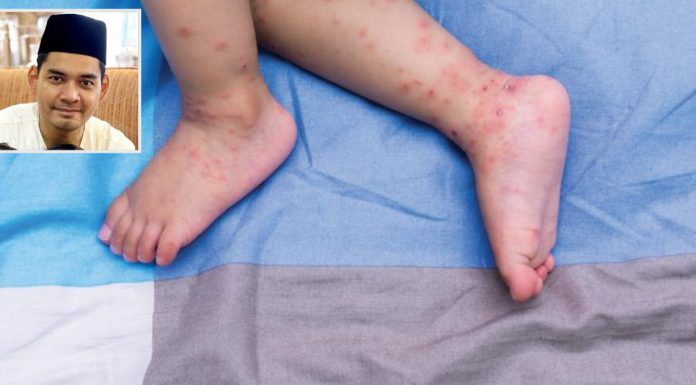 Demam, Ulser, Lepuh Di Tapak Tangan & Kaki Petanda Dijangkiti HFMD ...