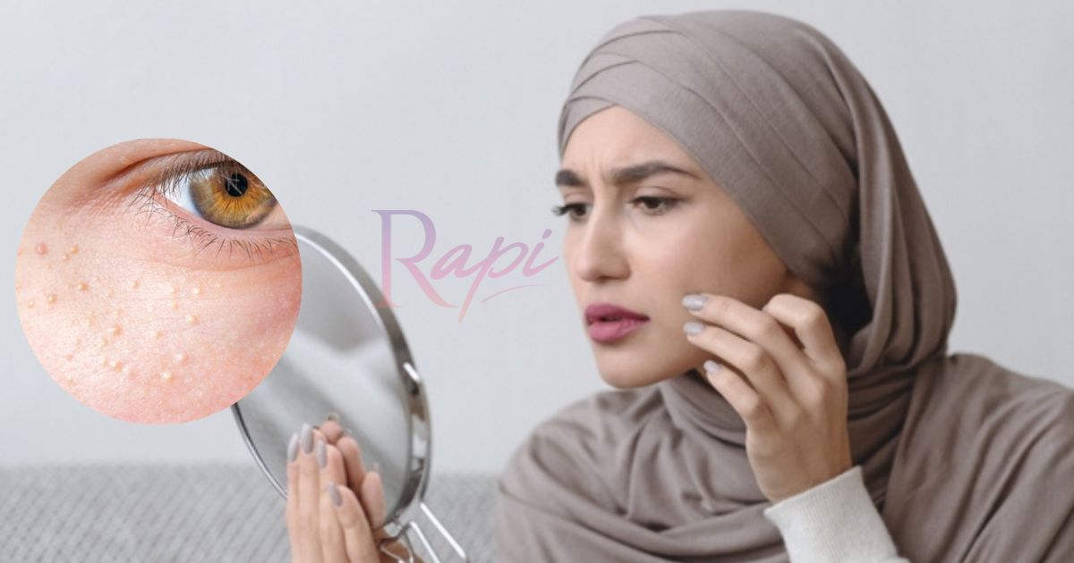 Jangan Picit Biji Kecil Di Muka, Bukan Jerawat Tapi Milia Seed. Ini ...